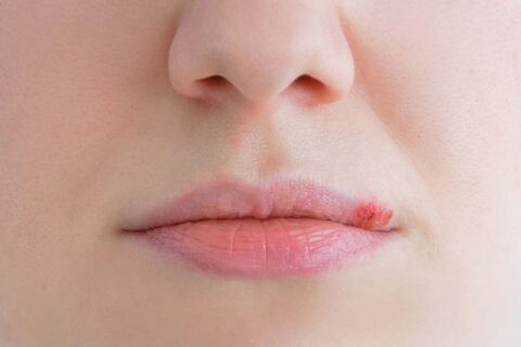 How to treat herpes successfully - sinnex.hu